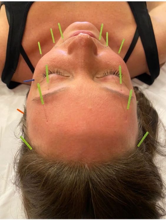 The Magic of Acupuncture: Can it Treat Bell’s Palsy? – Art Of Healing